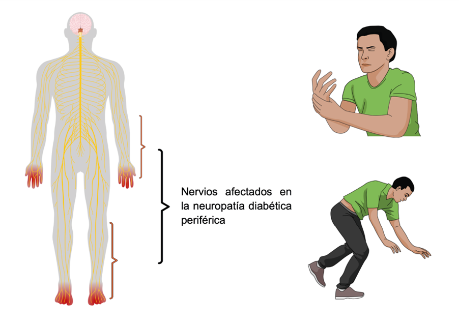 Polineuropatía Sensorial Distal - CIMET